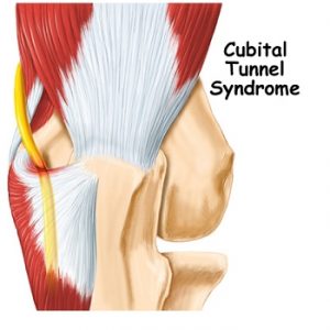 Cubital Tunnel Syndrome Ulna Nerve Compression At The Elbow