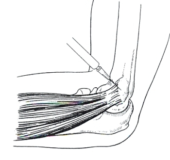 Golfers Elbow Medial Epicondylitis
