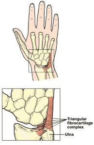 Ulna Sided Wrist Pain Tfcc