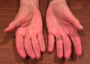 Thumb Base Arthritis