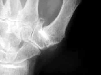Thumb Base Arthritis