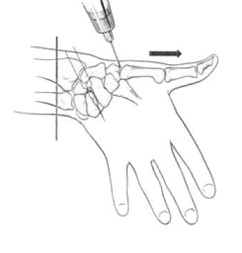 Thumb Base Arthritis 2