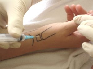 Thumb Base Arthritis 2