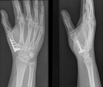 Thumb Base Arthritis