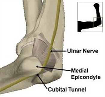 Ulnar Nerve Entrapment Cubital Tunnel Syndrome