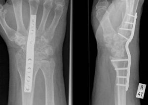 Wrist Fusion