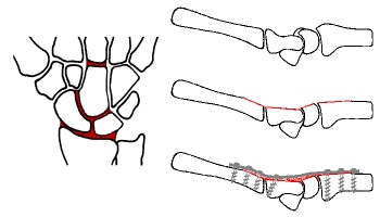 Wrist Fusion